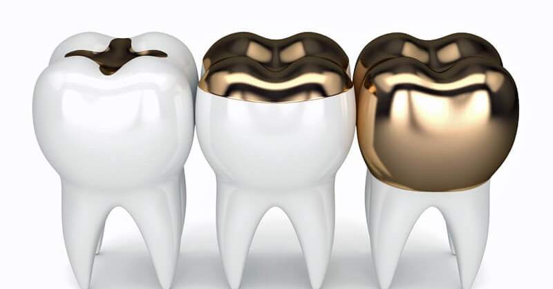 Inlays, Onlays & Overlays: Kosten, Arten, Vorteile & Nachteile