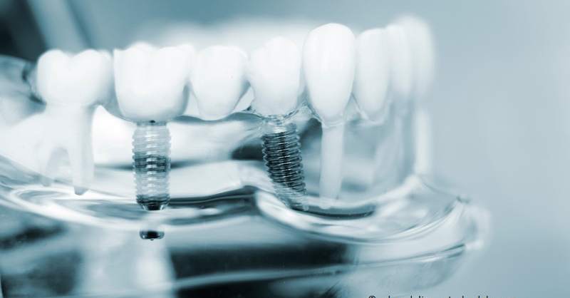 Mini-Implantate: Kosten, Behandlung und Vorteile