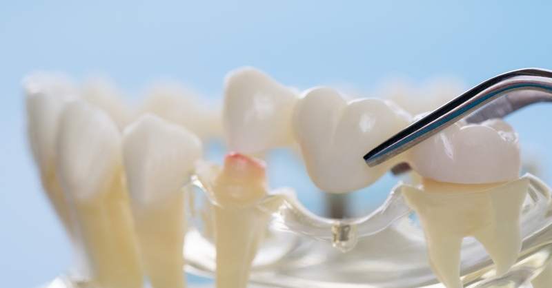 Zahnbrücke Kosten: Arten und Behandlung